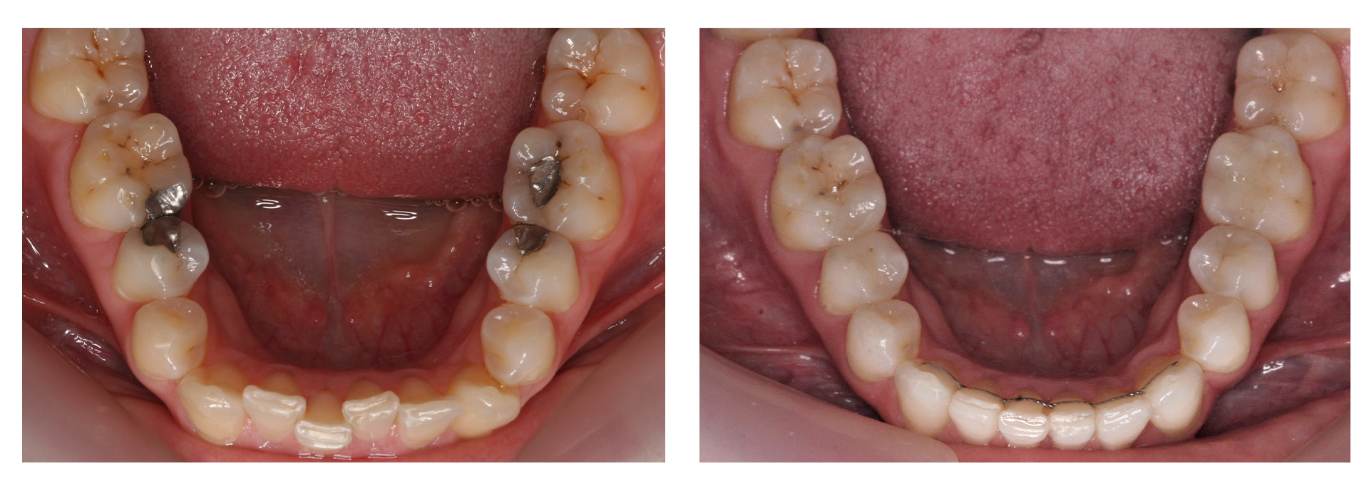 White Fillings Kent | Composite Teeth Filling | Pennypot